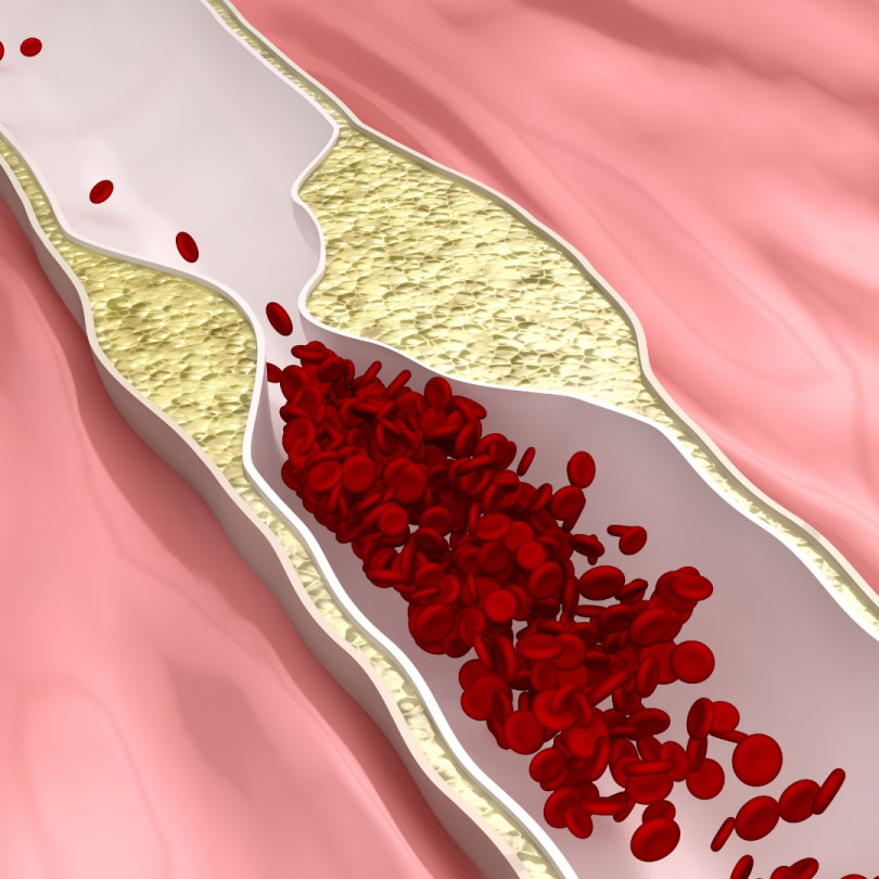 Peripheral Artery Disease & Foot Problems | MVS Podiatry Associates